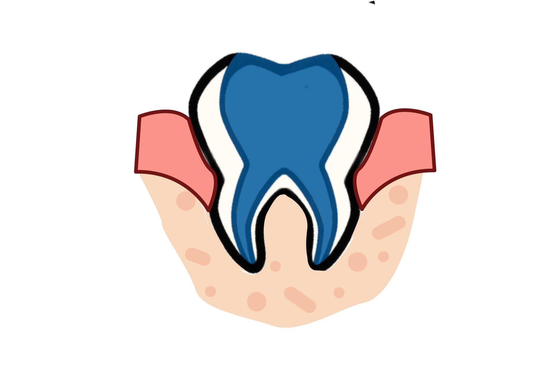 Treatment Option: Root Canal – Severe Pulpitis
